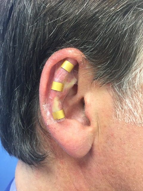 Protruding ears – Dr Raspaldo, Face and Neck surgeon