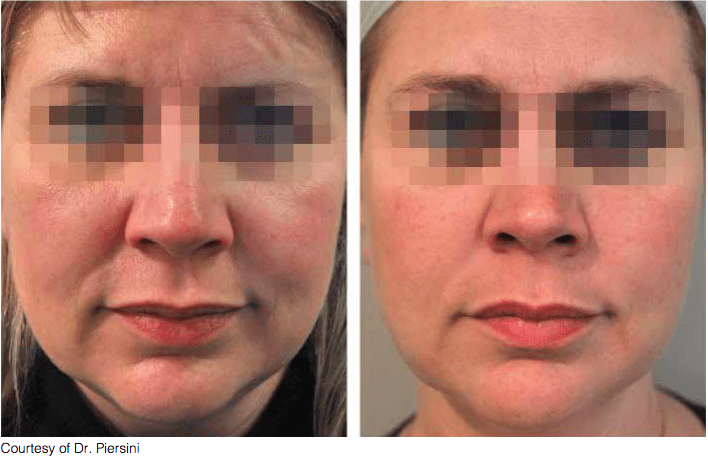 Skin radiance and reshaping by injection of Profhilo® – Dr Raspaldo ...