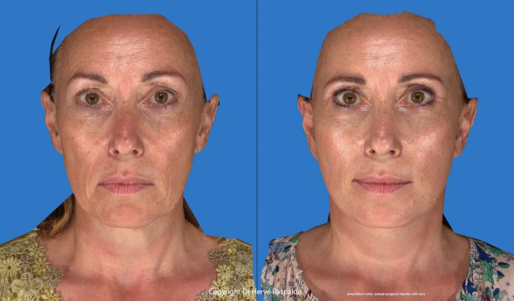 Endoscopic facelift – Dr Raspaldo, Face and Neck surgeon